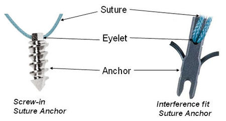 Bone and suture anchors - DolceraWiki